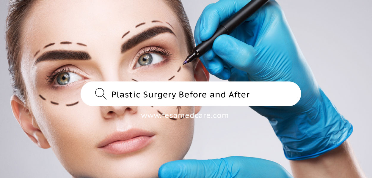 Plastic Surgery Before and After - Fesamedcare | Consultation with ...